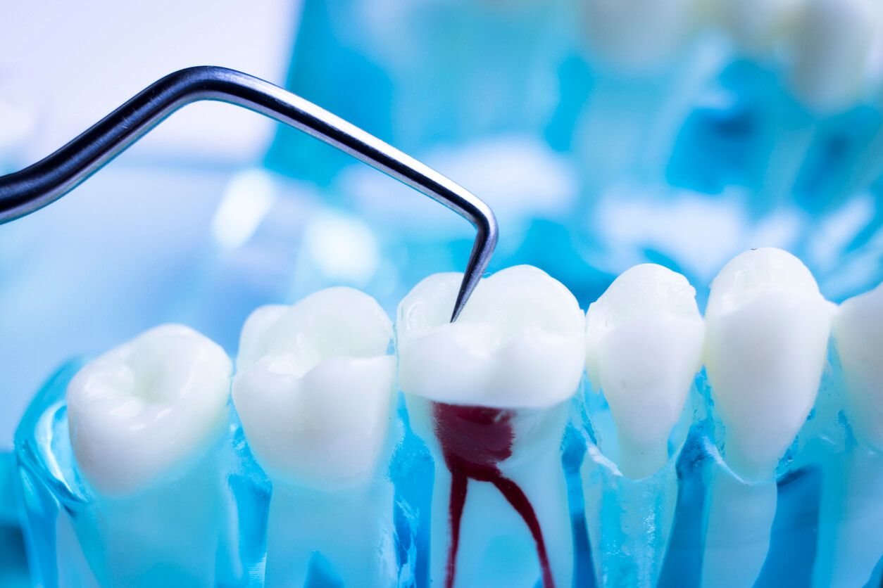 The Importance of Post-Root Canal Care: Tips for a Successful Recovery ...